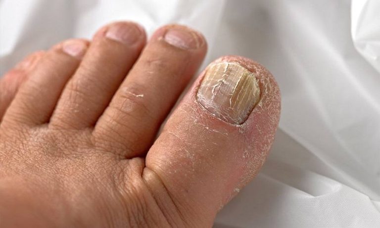 How to Get Rid of Nail Fungus | Adelaide Bunion Clinic